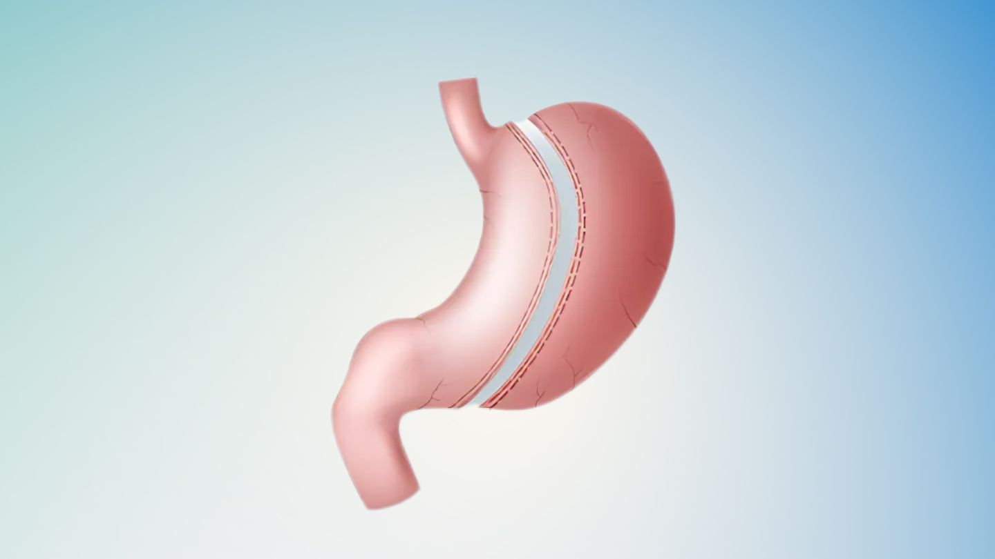 Weight Loss Surgery Types | Different Bariatric Surgeries Explained